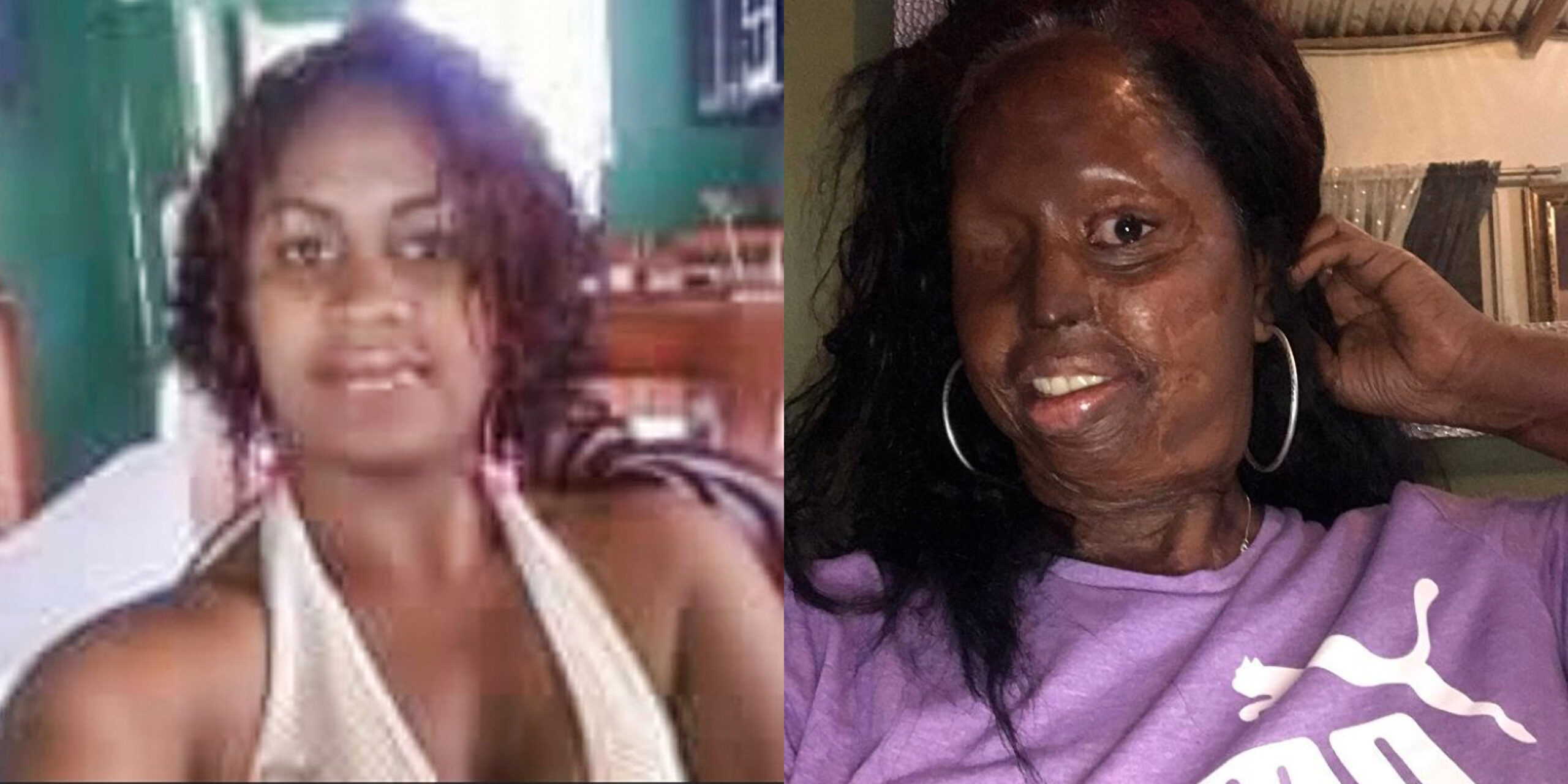 Acid Attack Victim Vows: ‘I’m Still a Beautiful Woman’ - The Westside ...